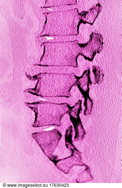 Significant Degenerative Lumbar Disc Disease In A 75 Year Old Woman