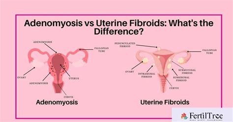 Adenomyosis Ruedisabrije