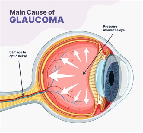 Glaucoma Causes Symptoms Diagnosis And Treatment