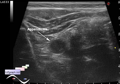 Retroperitoneal Appendicitis Abdomen Sonography Clinical Report