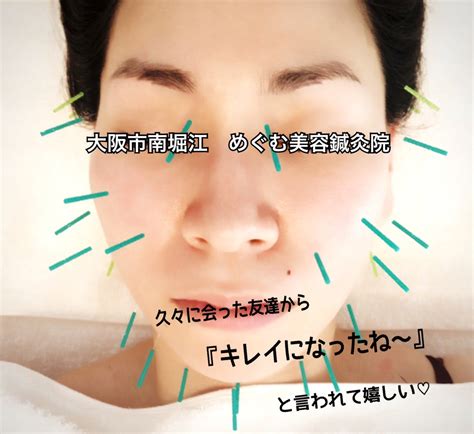 キレイになる？【美容鍼】めぐむ美容鍼灸院♪ 大阪難波・堀江でリフトアップなら美容鍼×美容エステの女性専用【めぐむ美容鍼灸院】