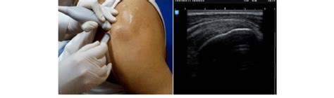 Musculoskeletal Ultrasound Guided Steroid Injection By The Subacromial
