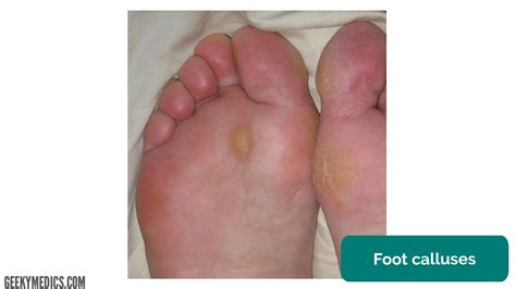 Ankle And Foot Examination Osce Guide Geeky Medics