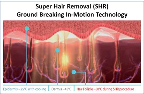 Super Hair Removal Shr Effective Laser Hair Removal Spectrum