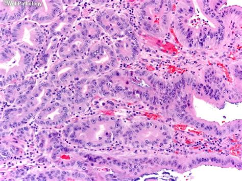 Barrett Esophagus High Grade Dysplasia