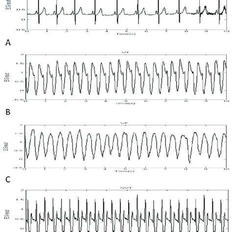Instances Of A Normal B Ventricular Tachycardia Vt C Ventricular