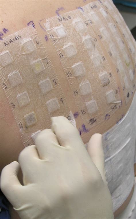 On Patch Testing And The True Test Dermatitis Academy