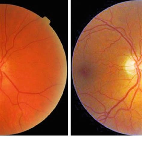 Examples Of Non Uniform Illumination Correction By Smoothing Splines Download Scientific