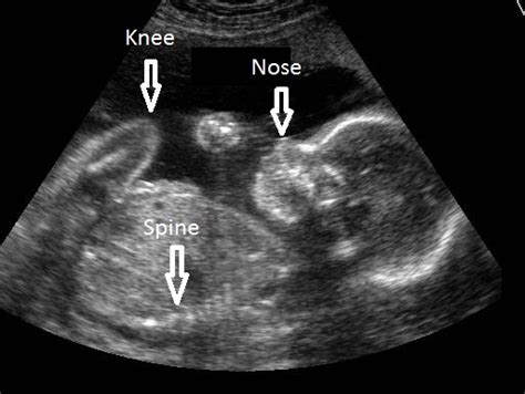 Everything You Need To Know About Ultrasounds During Pregnancy