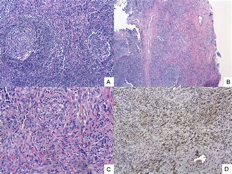 A Lymph Node With Hyalinized Germinal Centers And Expanded Mantle Download Scientific Diagram