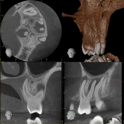 Cutaneous Sinus Tract A Case Report Oral Health Group