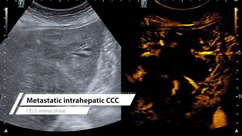 Let S Learn Ceus 008 Metastatic Cholangiocarcinoma Youtube