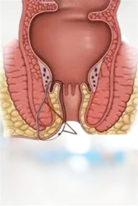 Kshara Sutra Ayurveda Treatment Sai Ayush Ayurveda