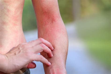 Fire Ant Bites Treatment And Relief From The Itch Efi