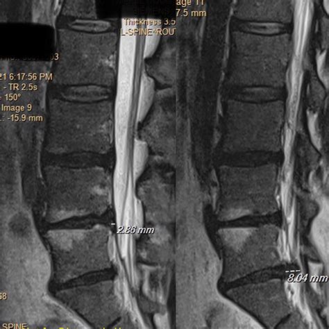 Herniated Disc Mri Take 2 Rsciatica
