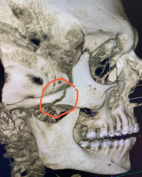 Ufc Star Dan Hooker Suffers Broken Cheek Bone As He Shares Skull X Ray