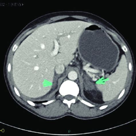 Selected Single Axial Cut From Abdominal Computed Tomography