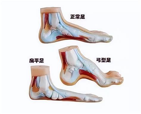 冉冉科普 一踩地就疼的足底筋膜炎，到底是怎么回事？ 哔哩哔哩