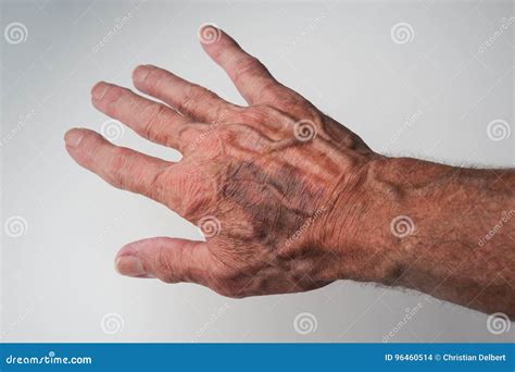 Bruises From Blood Collection Isolated On White Background Royalty