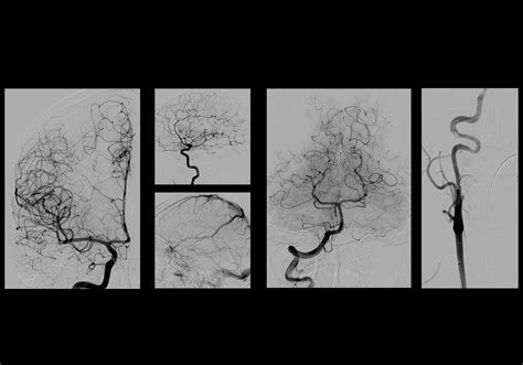 Arteries Of Brain Angiography Normal Anatomy E Anatomy