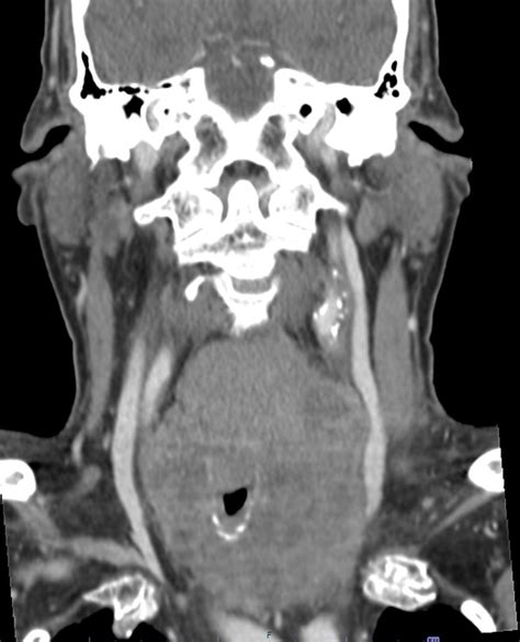Más allá de lo habitual Neoplasias malignas tiroideas infrecuentes en
