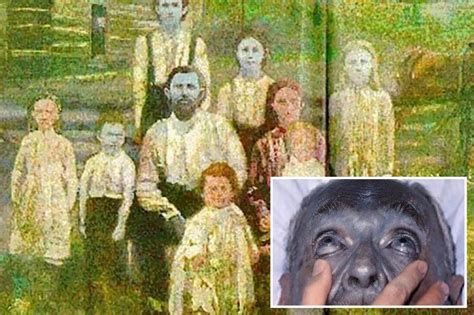 Genetic Blue Skin Condition Methemoglobinemia Cured With Methylene Blue