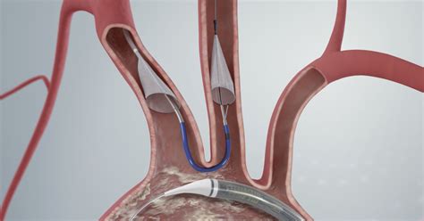 Tavr Embolic Protection Devices Fail To Reduce Stroke Risk But Some