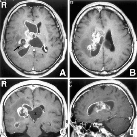 Figure 1 From Choroid Plexus Carcinoma Secreting Carbohydrate Antigen