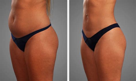 Fibrosis Go Away After Lipo Causes Symptoms And Treatments