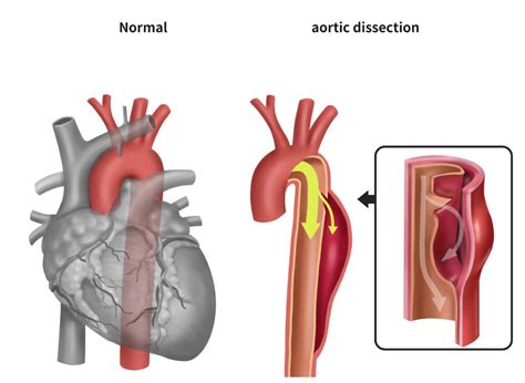 Aortic Dissection Early Detection Treatment And Prevention