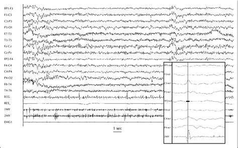 Jle Epileptic Disorders Epilepsy And Neurodegenerative Diseases In