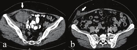 Abscess Arrow In Right Lower Quadrant On Preinterventional Ct A Download Scientific