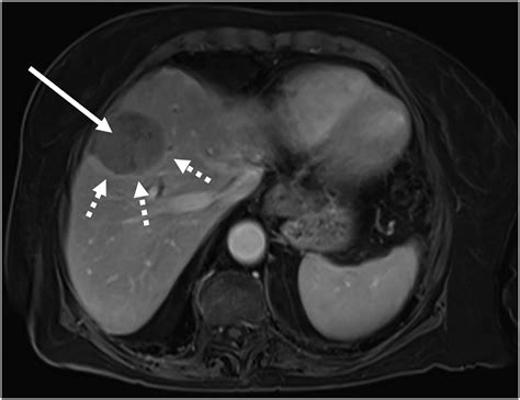 Dynamic Contrast Enhanced Dce Mri Magnetic Resonance Imaging Clinics