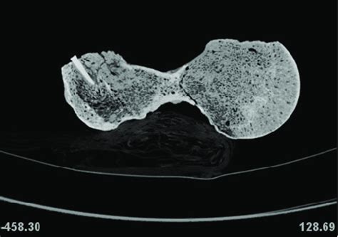 Tomografía Transversal De La Epífisis Proximal Del Fémur Donde Se Download Scientific Diagram