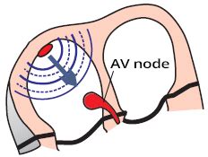 Second Degree AV Block Conduction 2 1 ECG Book