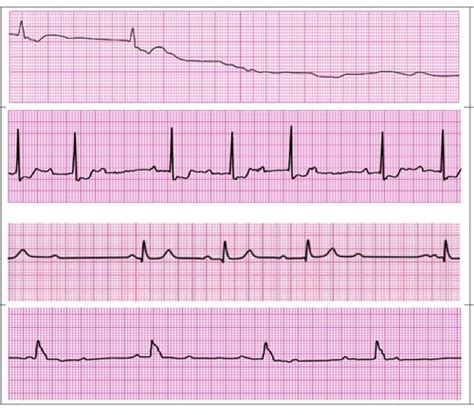 Acls Flashcards Quizlet