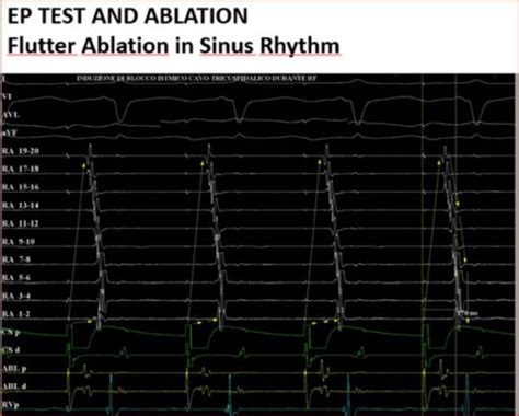 Atrial Flutter AFL Ablation AF ABLATION
