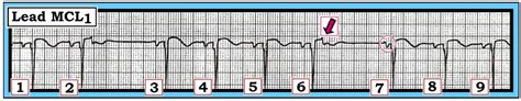 Ecg Interpretation Ecg Blog 14 — The Cause Of The Pause