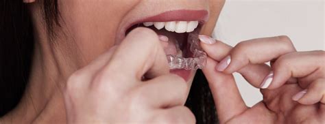 How Invisalign Works Science Behind Clear Aligners