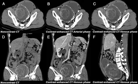 Giant Melanotic Malignant Peripheral Nerve Sheath Tumor In T