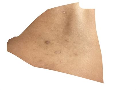 Help Chest Lower Back Acne And Darkspots R Acne