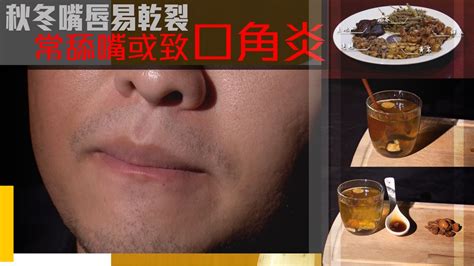 【最強生命線】大夫斷症：秋冬嘴唇易乾裂 常舔嘴或致口角炎 無綫新聞tvb News