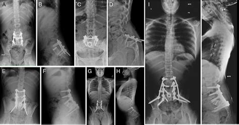 Spinal Osteosarcoma In The Paediatric Age Group Case Series And