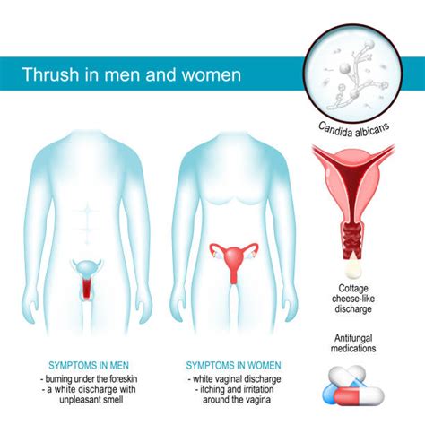 Male Yeast Infection Candida Balanitis Symptoms Causes Treatment Atelier Yuwaciaojp