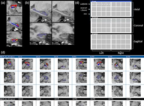 Exemplary Overlays Of Full Segmentation Results Combined Hippocampal Download Scientific