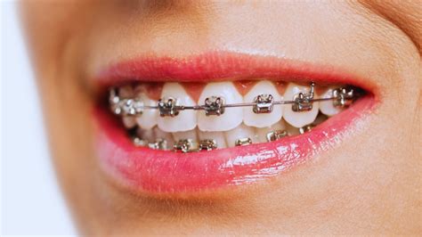 Dental Braces Treatment Complete Timeline And What To Expect