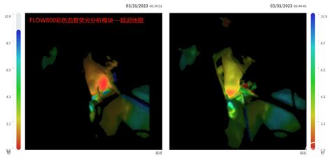 【双镜联合】基于qevo与flow 800彩色血管荧光技术的颅内多发动脉瘤夹闭术 脑医汇