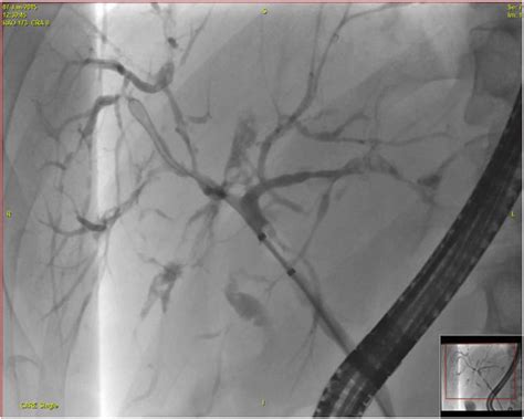 Typical Cholangiographic Findings Of Primary Sclerosing Cholangitis Download Scientific