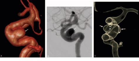 Figure 1 From Bone Subtraction Ct Angiography For The Evaluation Of