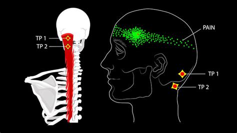 Semispinalis Trigger Points And Muscle Pain Dr Chernov